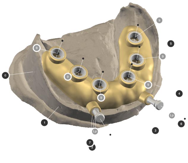 Implant 3D - Implant Planning Software and Surgical guide creation ...