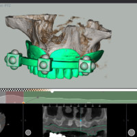 Implant 3D - Implant Planning Software and Surgical guide creation ...